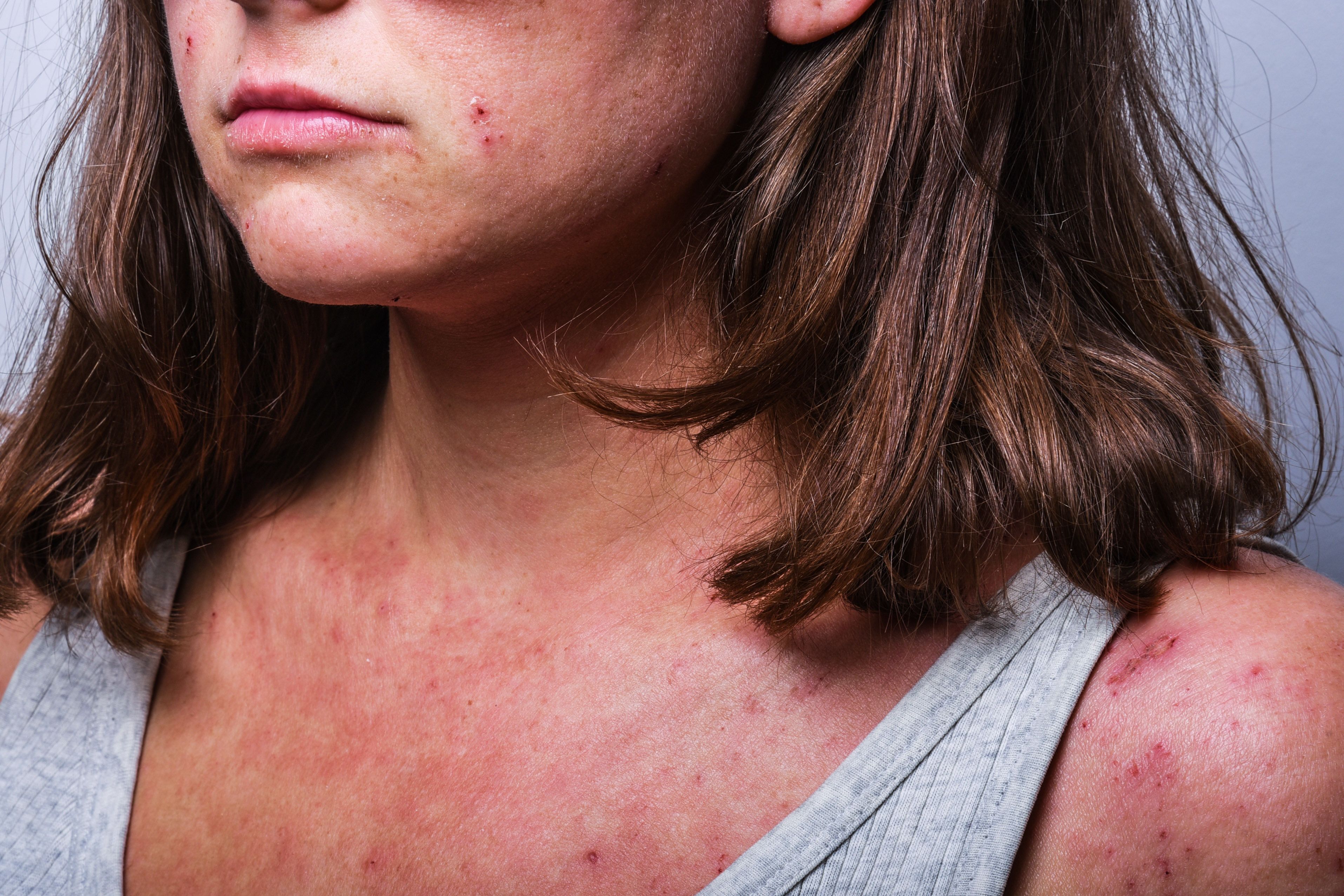 FDA Approves Expanded Indication for Adbry in Atopic Dermatitis ... FDA Approves Expanded Indication for Adbry in Atopic Dermatitis ...
