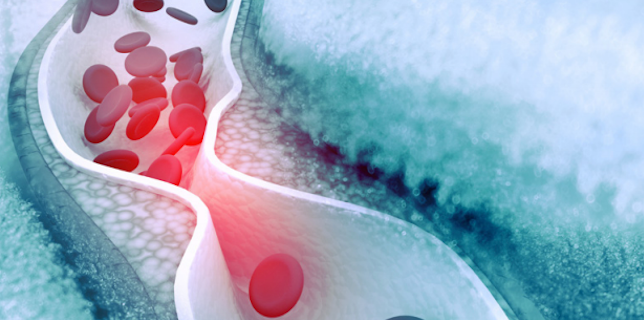Statins Are a Standard Treatment Component for Certain Patients With Cancer