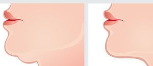 FDA Approves Treatment for Fat Below the Chin