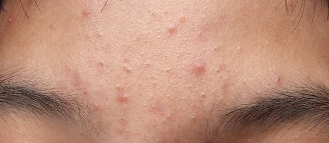 Sarecycline Granted FDA Approval for Acne Vulgaris