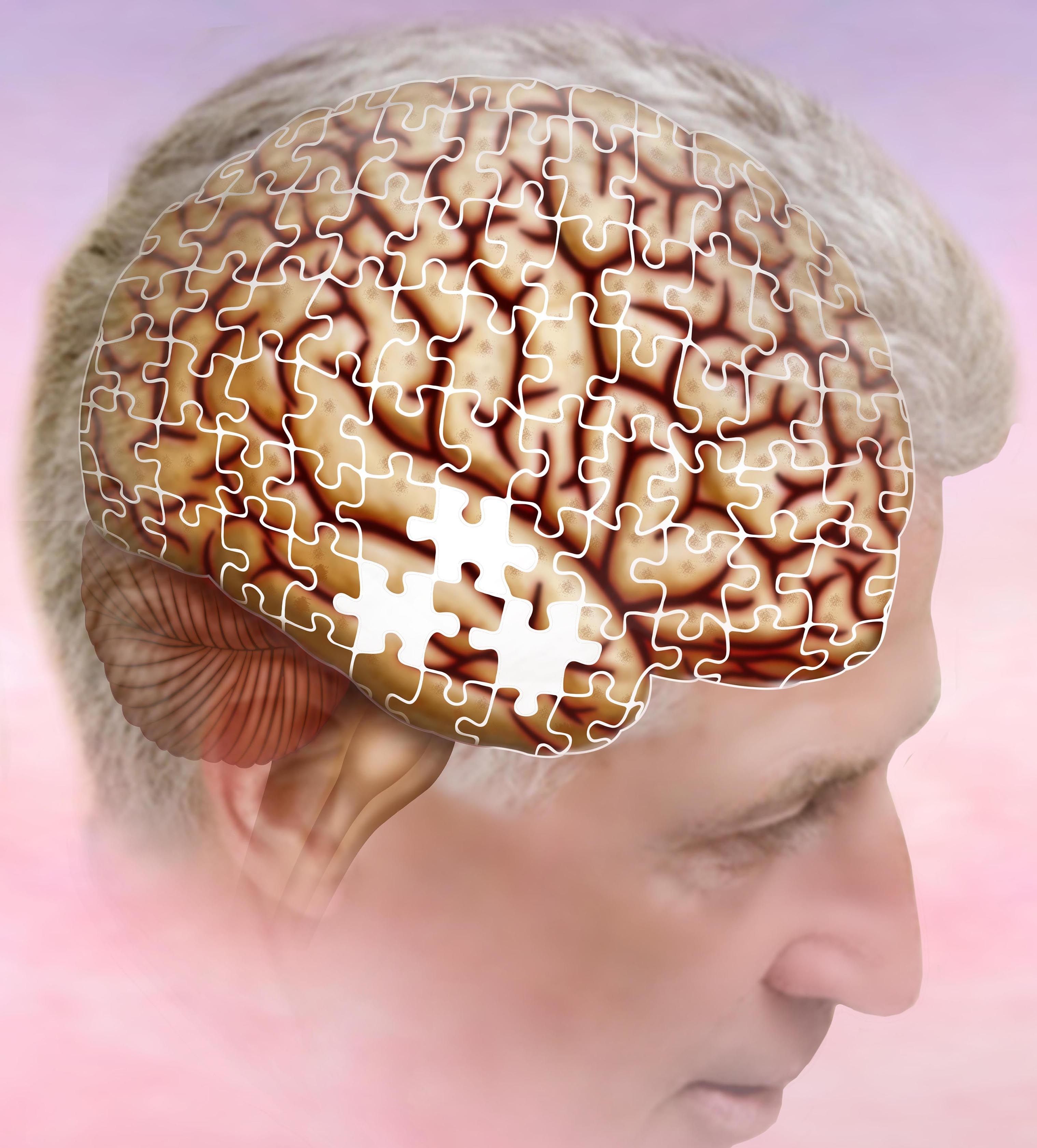 Brain Protein Found to Contribute to Pancreatic Cancer Development