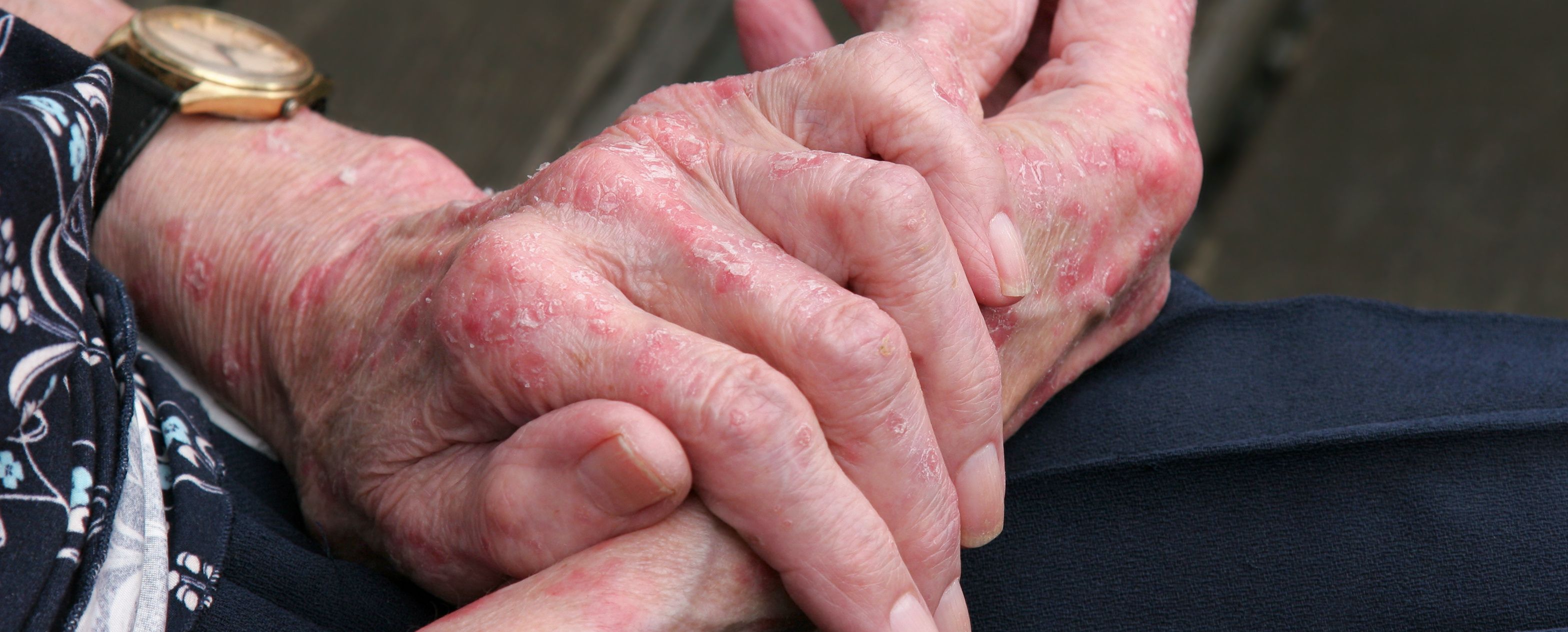 Actavis Launches Generic Temovate Cream | Pharmacy Times