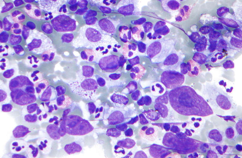 Combination of Ivosidenib Plus Azacitidine Produces Survival Benefit in ...