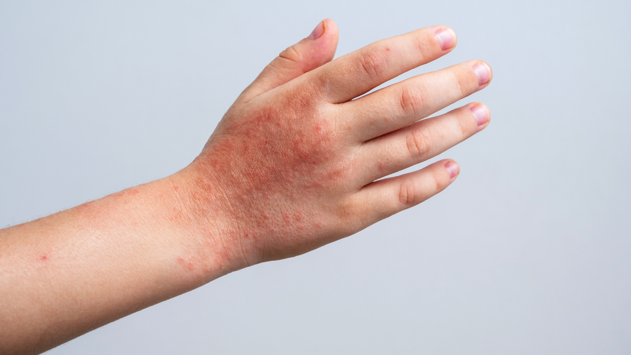 FDA Approves New Prefilled Syringe Presentation of GSK’s Shingrix for ...