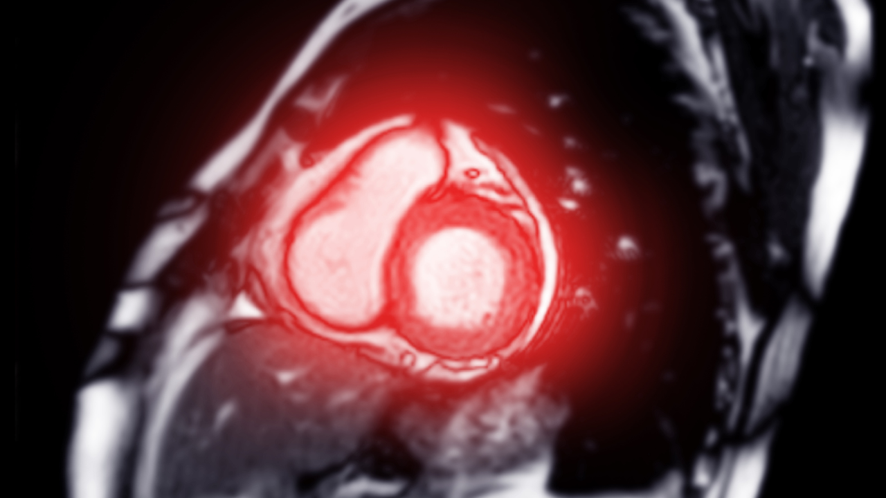 Fda Approves Evolut Tavr System Medtronics Treatment For Symptomatic