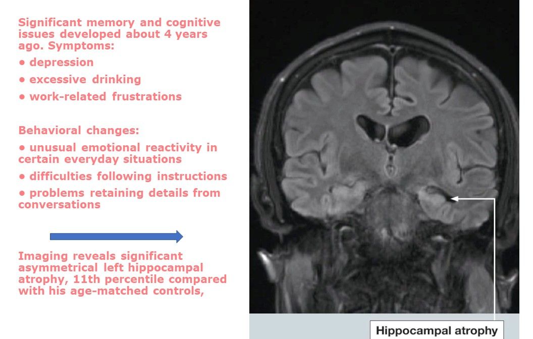 4 Stages of Chronic Traumatic Encephalopathy | Psychiatric Times