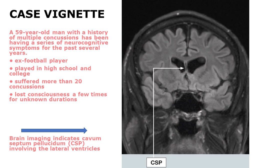 4 Stages of Chronic Traumatic Encephalopathy