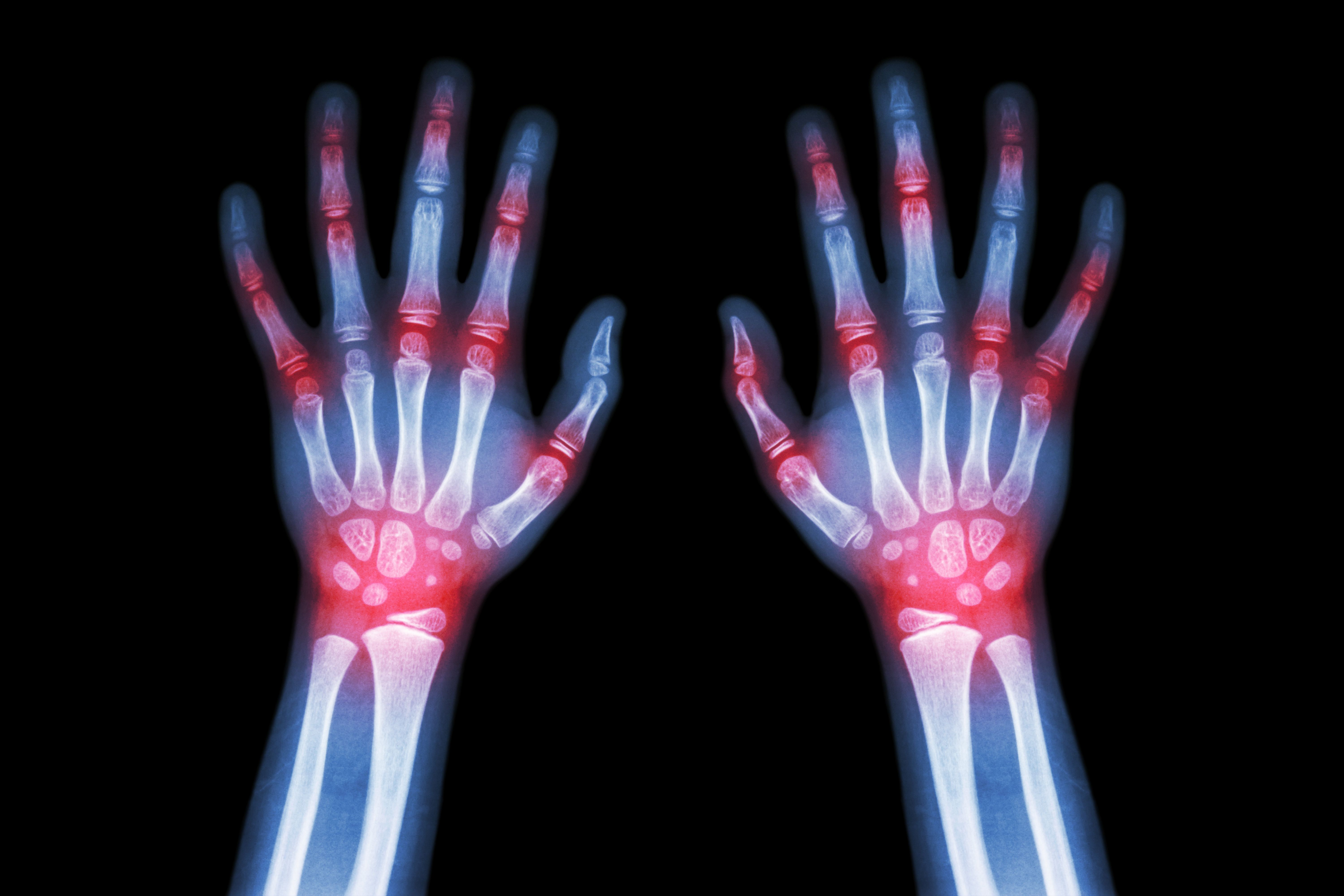 Etanercept Trial Supports Use for JIA, ERA and PsA | Rheumatology Live