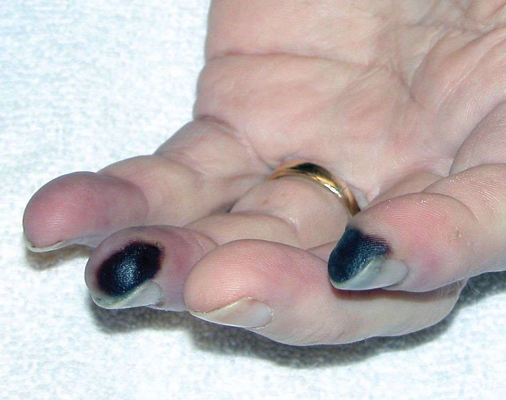 Ulcers and Gangrene in the Hands and Feet of a 56-Year-Old Man ...