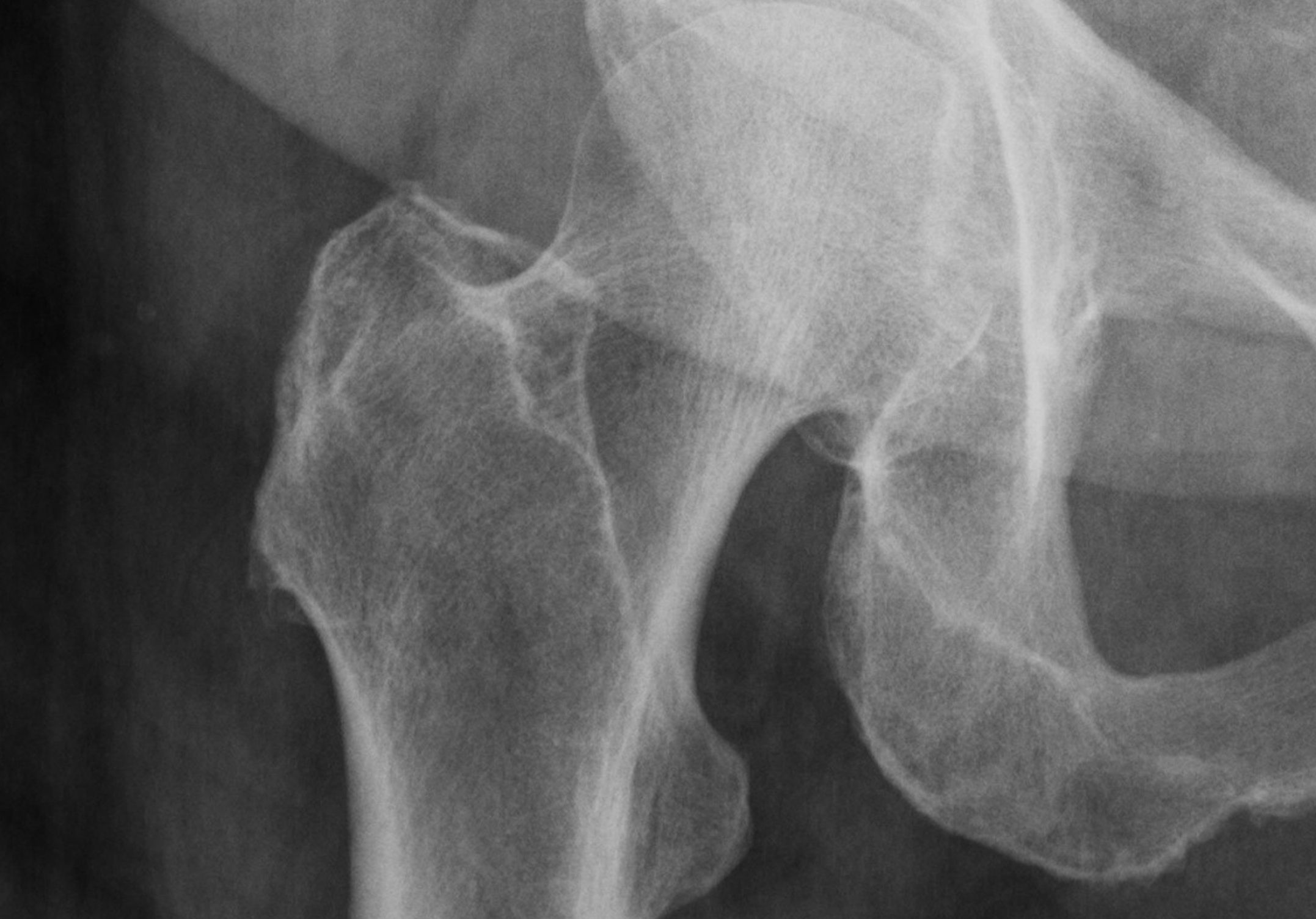 FRAX Score Improves Secondary Fracture Prevention | Rheumatology Live