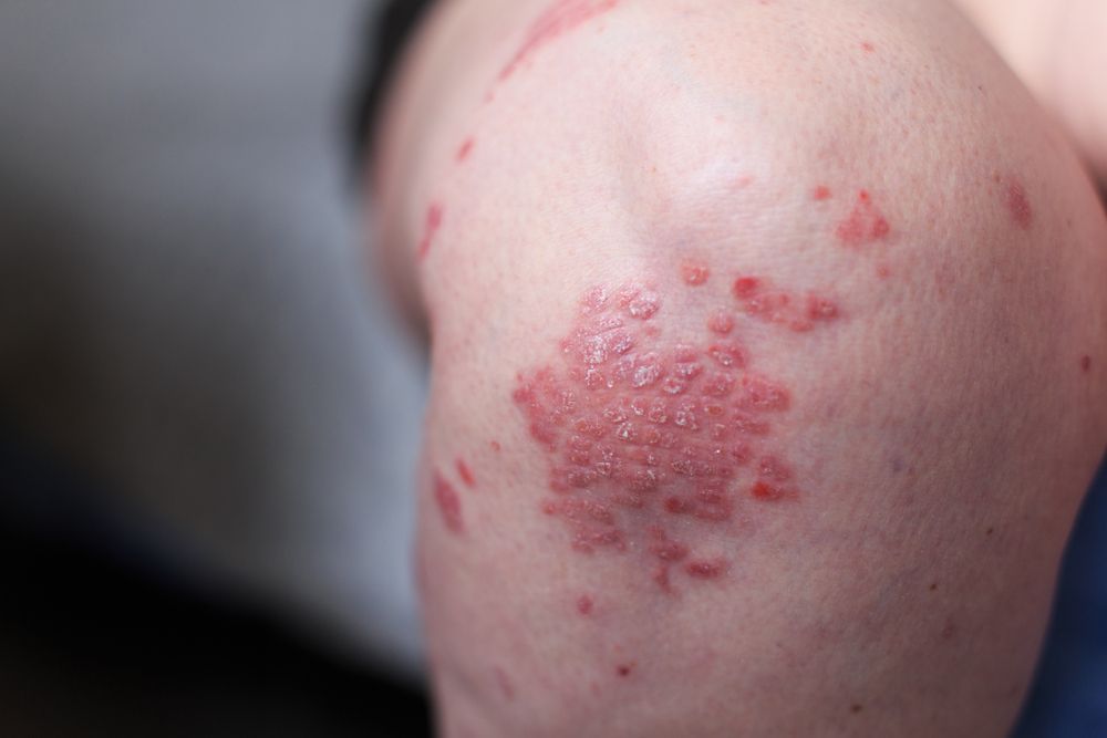 Methotrexate Use in Psoriasis with Arthritis Revisited | Rheumatology Live