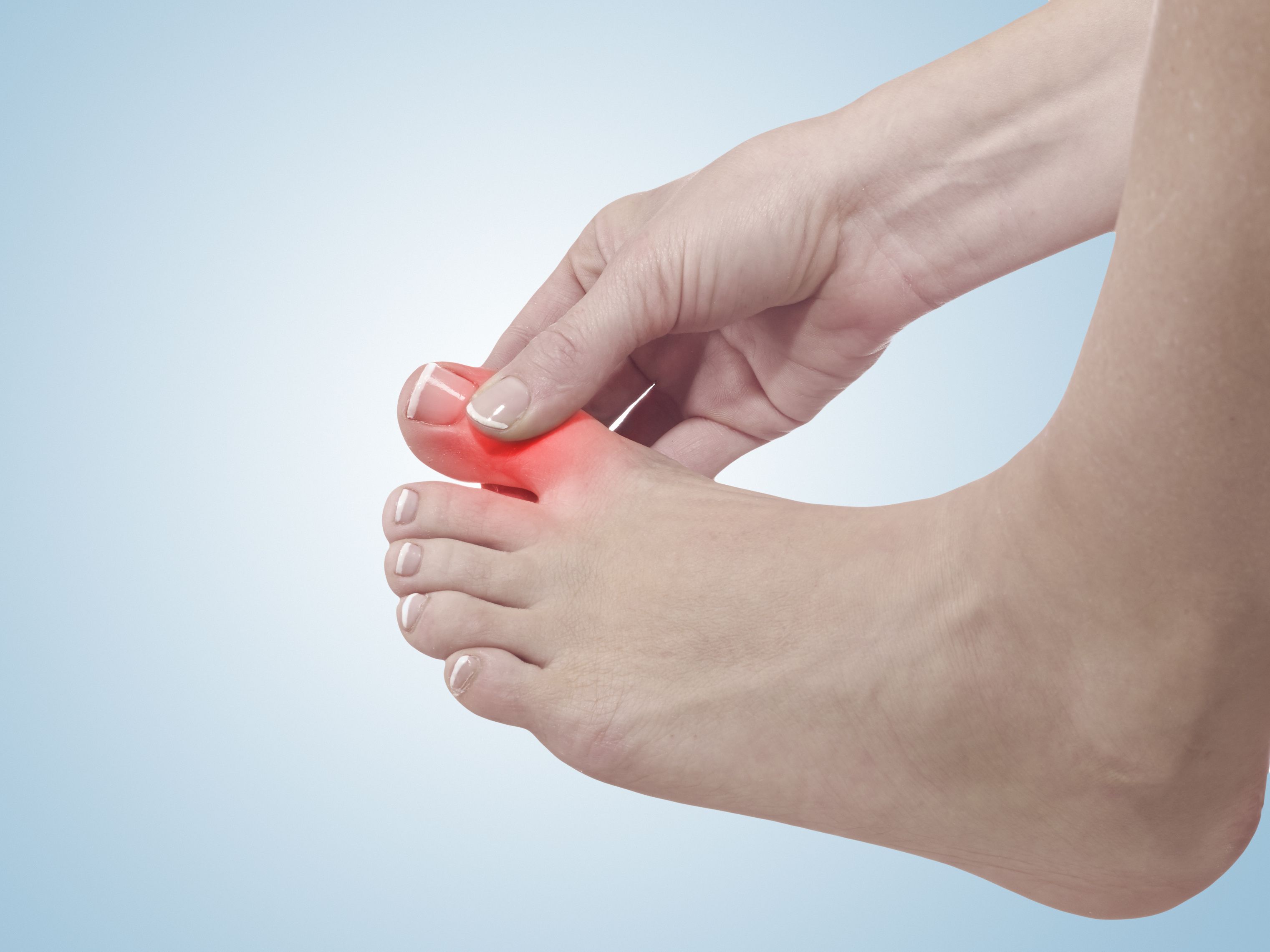 Early Urate-Lowering Treatment did not Increase Flare Severity ...