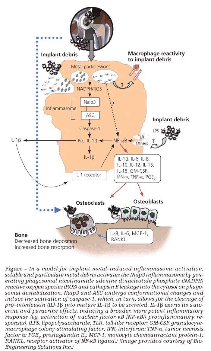 Inflammatory bone loss in joint replacements: The key mediators ...