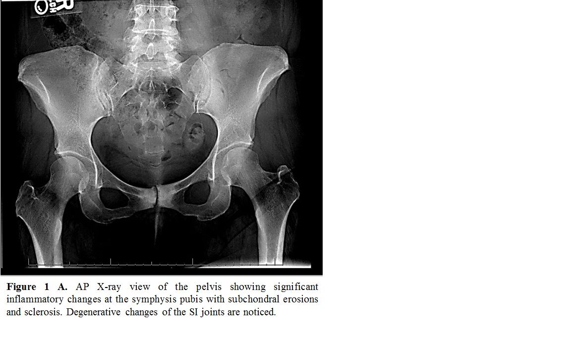 An Unusual Presentation of Ankylosing Spondylitis Involving the ...