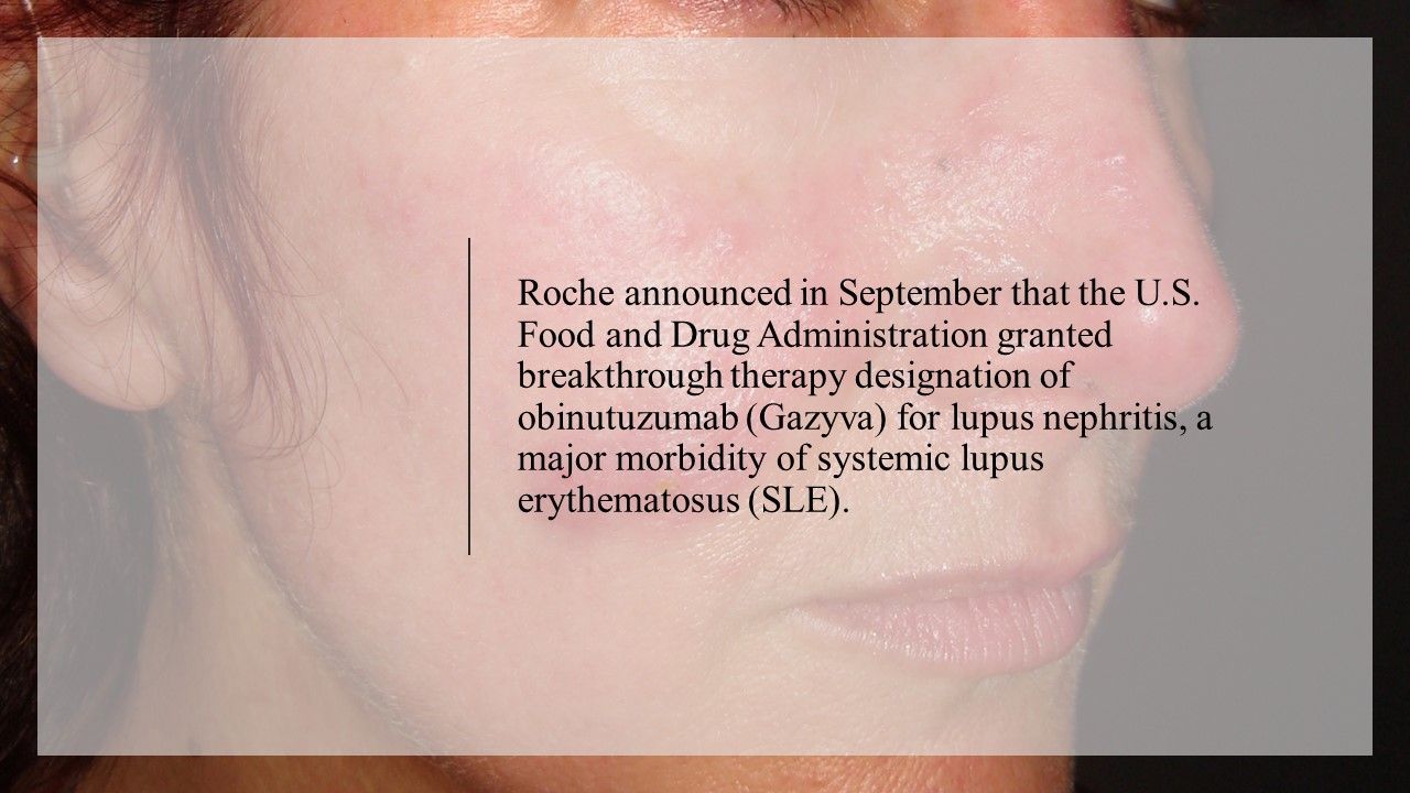 2019's Top Treatment Advances in Lupus