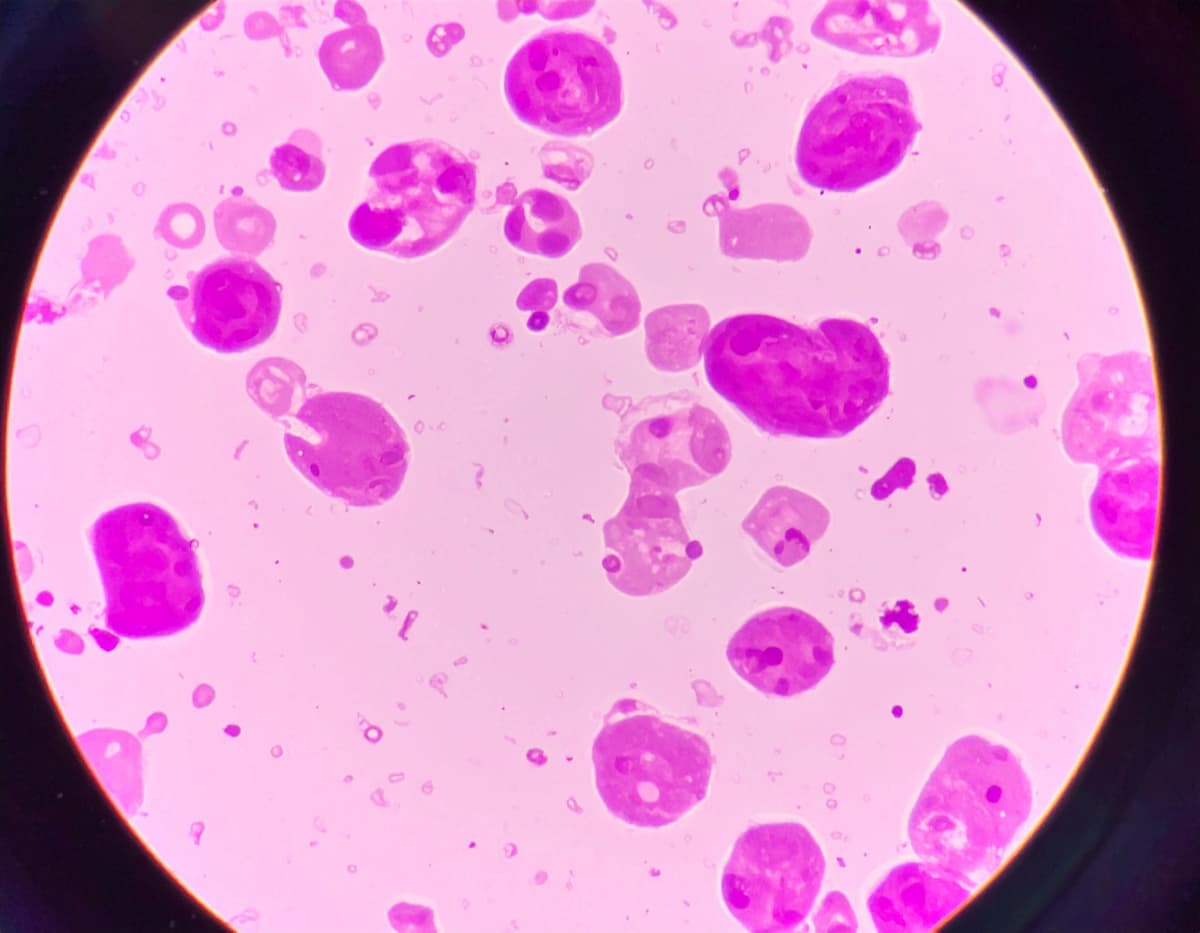 Epcoritamab Combo Shows Benefits in Phase 3 Follicular Lymphoma, Moves ...