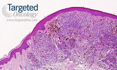 Trametinib and Dabrafenib Combo Successful in Melanoma