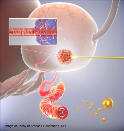 Prostate-sparing treatment using nanoparticles shows promise