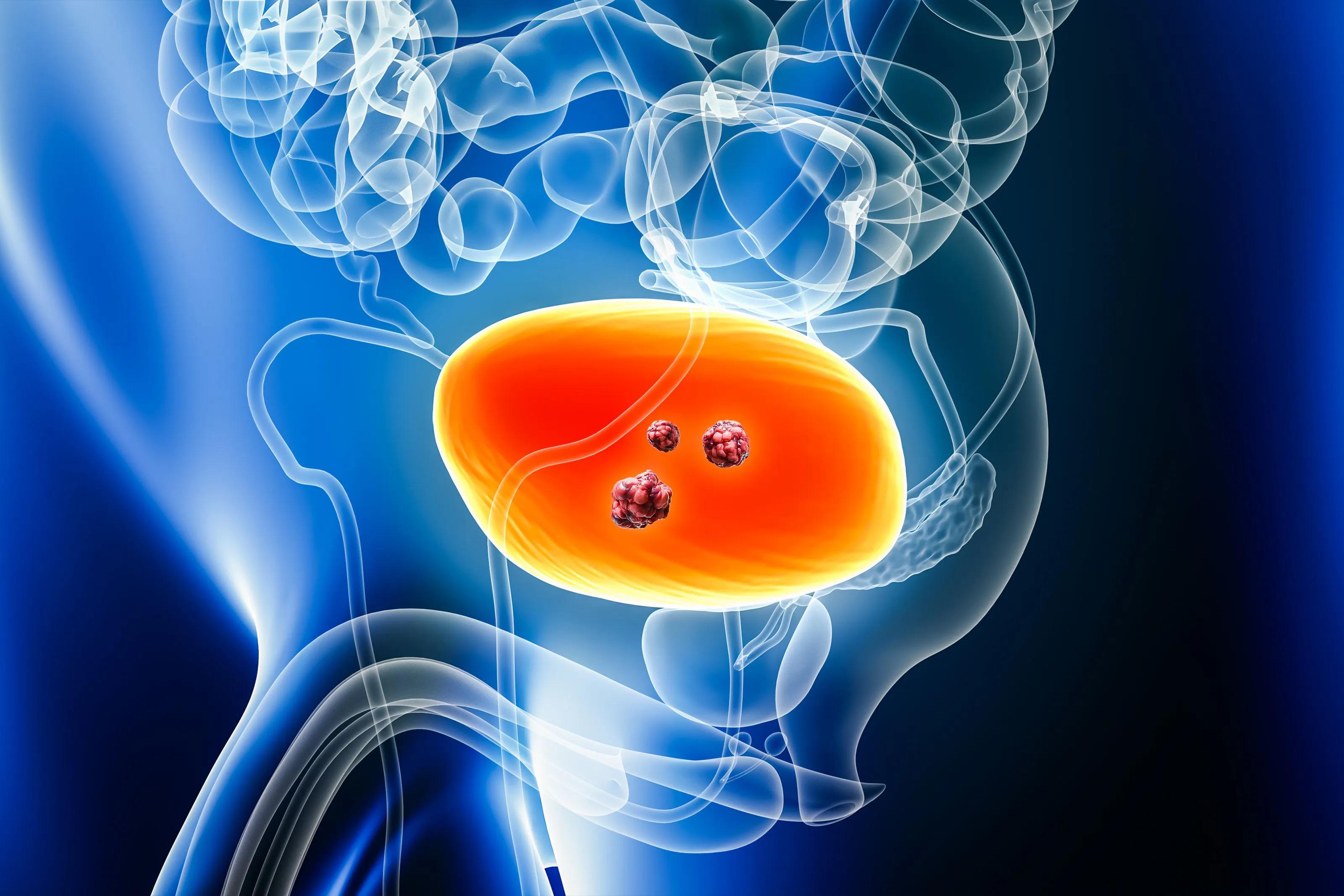 Neoadjuvant Sacituzumab Govitecan Shows Efficacy But Now Has Uncertain Future Role In Bladder Cancer