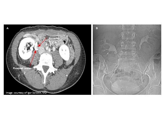 Quiz: Chronic right flank pain in a slender female