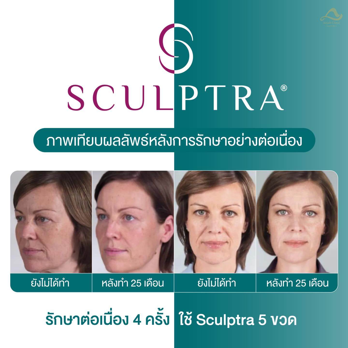 Sculptra invites you to experience age reduction like never before! Our ...