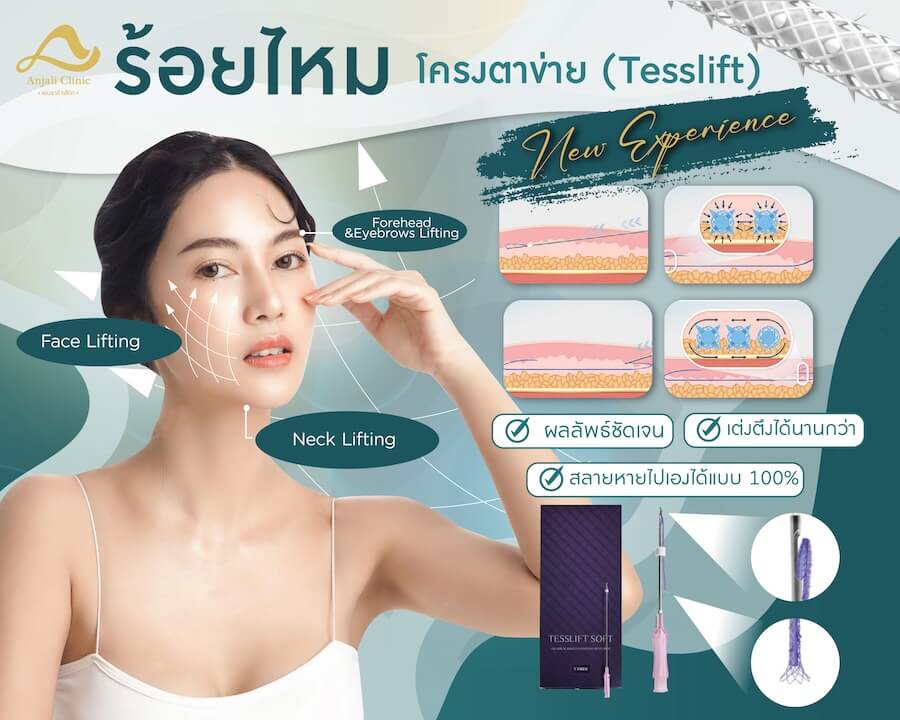 Tesslift lifting by specialist doctor of Anjali Clinic - คลินิคแอนจาลี