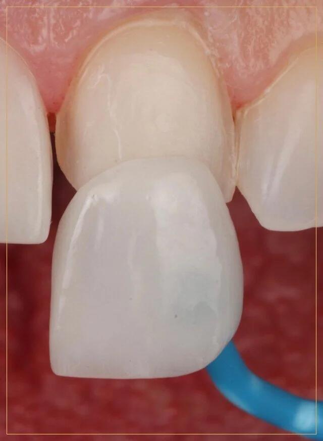 Porcelain veneers by top cosmetic dentist in Houston