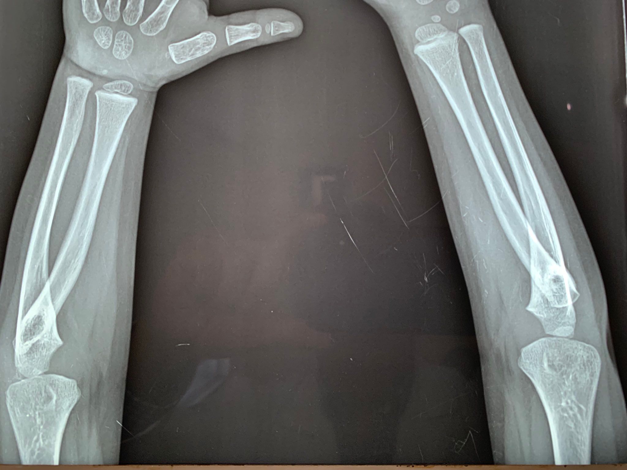 Sinostosis congénita radiocubital proximal . Dr. Benito Saavedra Alvarado