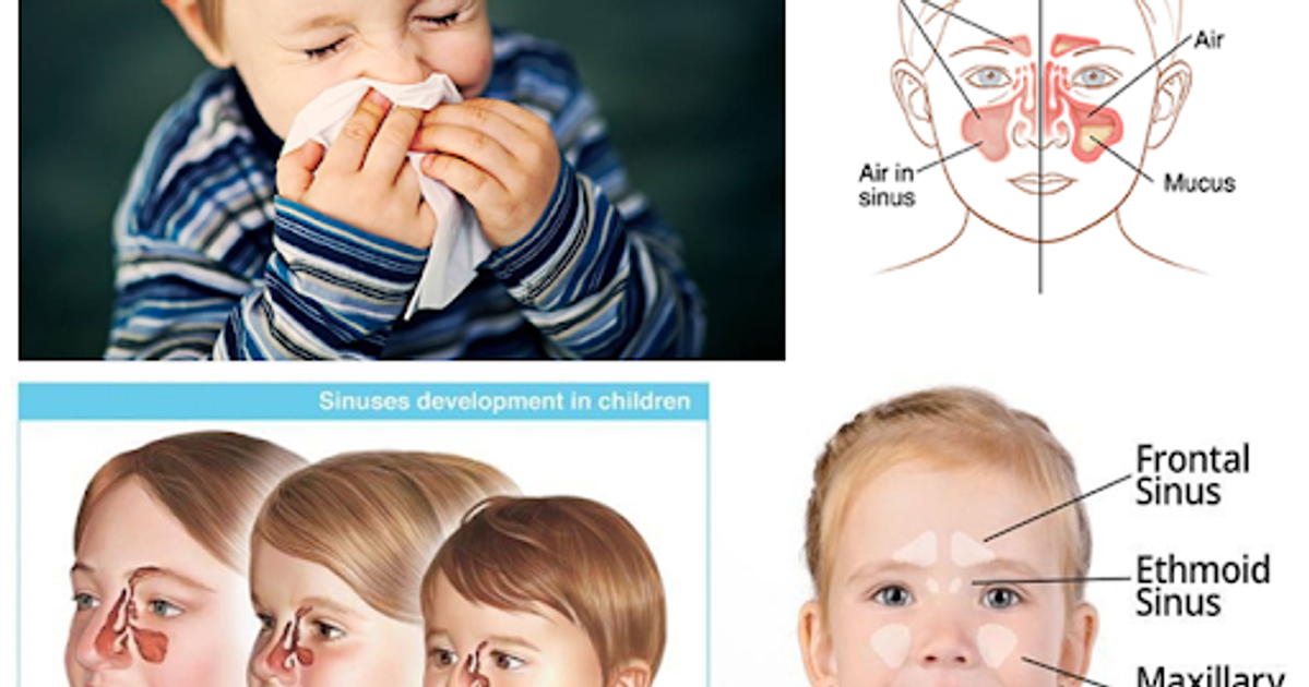 Pediatric Sinusitis: Causes, Symptoms, Treatment, Prevention