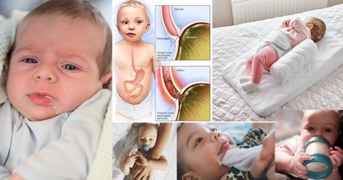 Baby Regurgitation (Reflux): Causes, Symptoms & Management