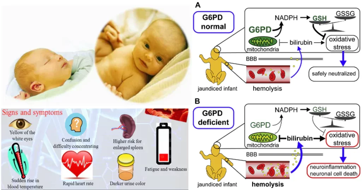G6PD Deficiency in Babies: A Parent's Guide to Causes