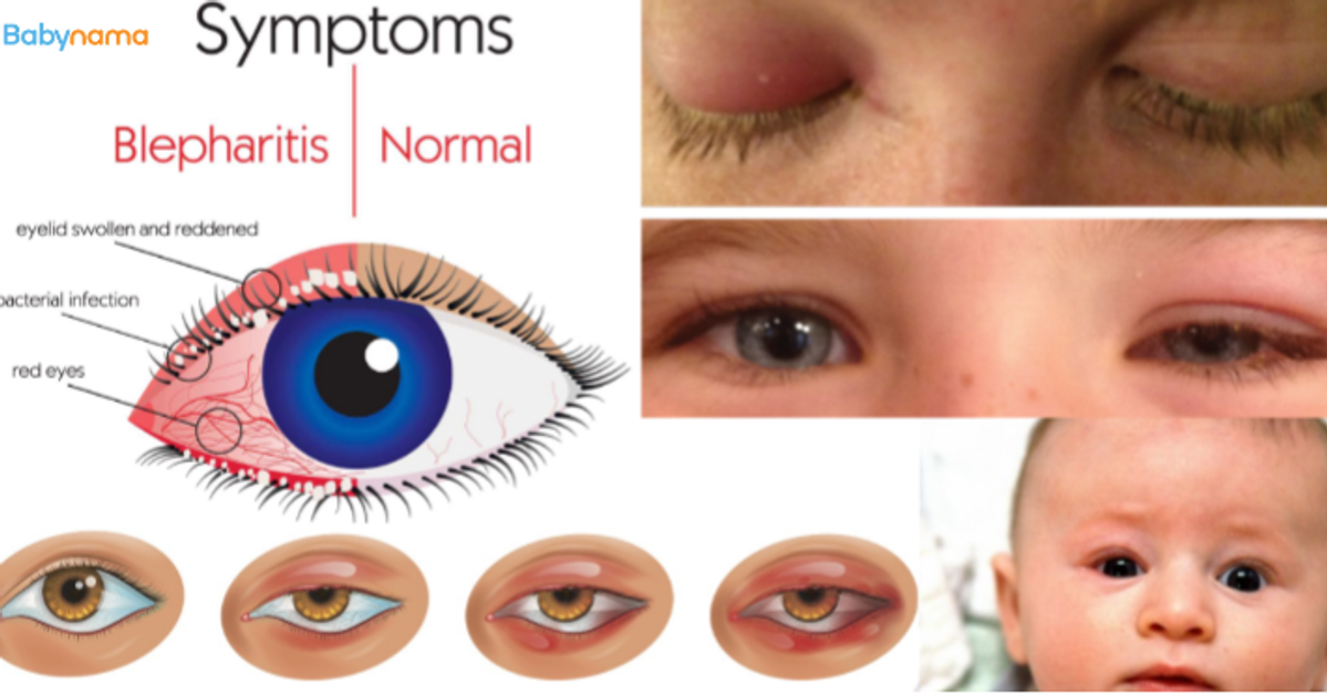 Blepharitis in Kids: A Guide to Causes & Symptoms