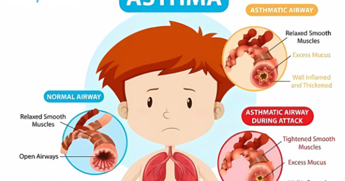 Childhood Asthma: A Guide to Symptoms & Treatment