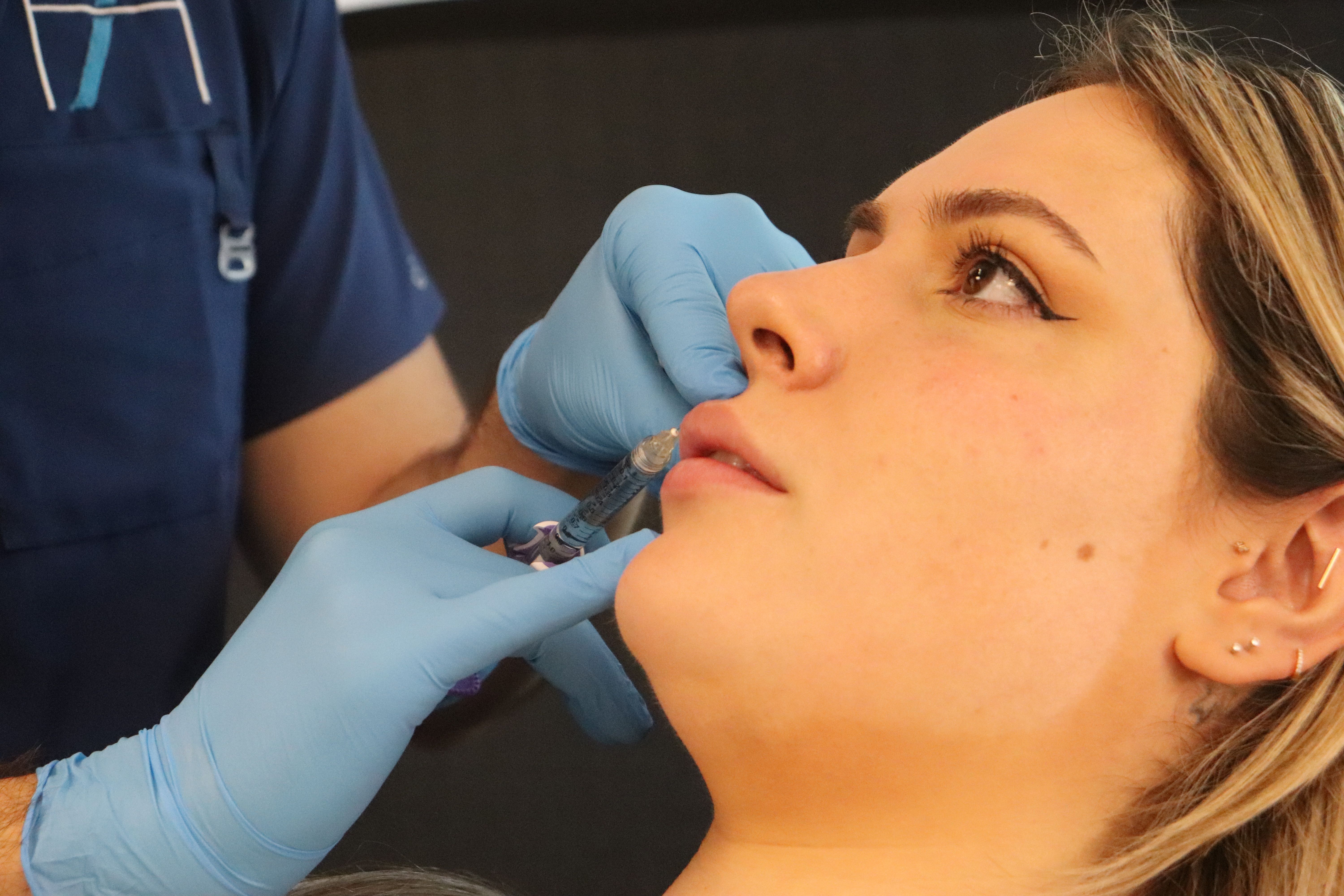 Perioral & Lip Filler