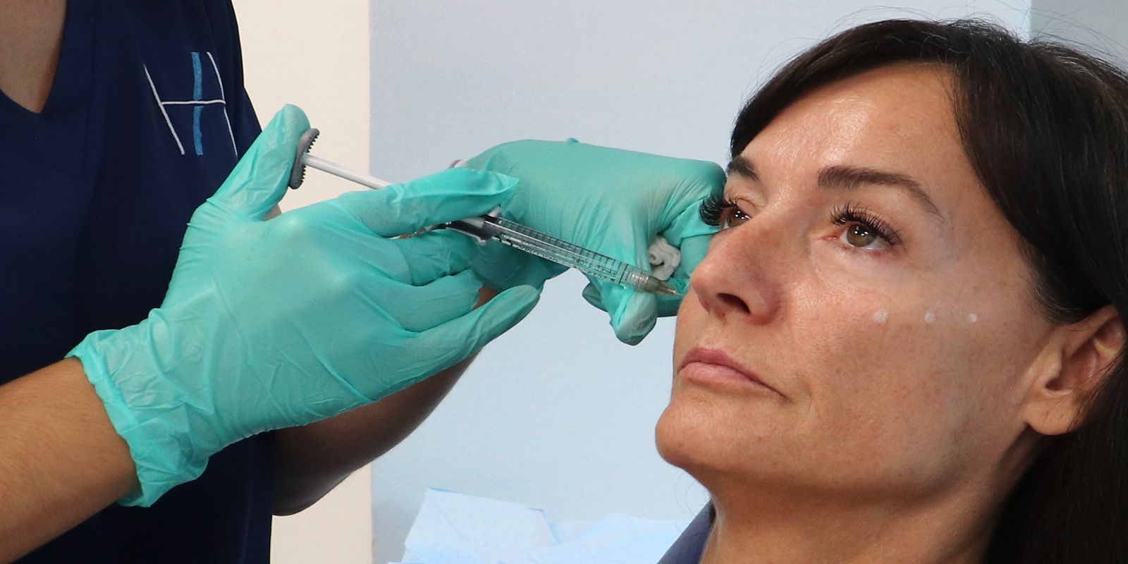 Cheek Filler Techniques: Medial V Lateral Treatments