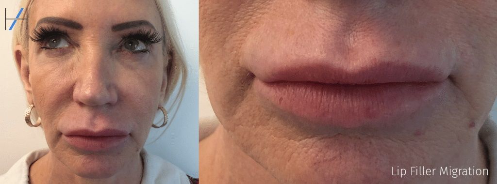Dermal Filler Migration Prevention and Management | Harley Academy