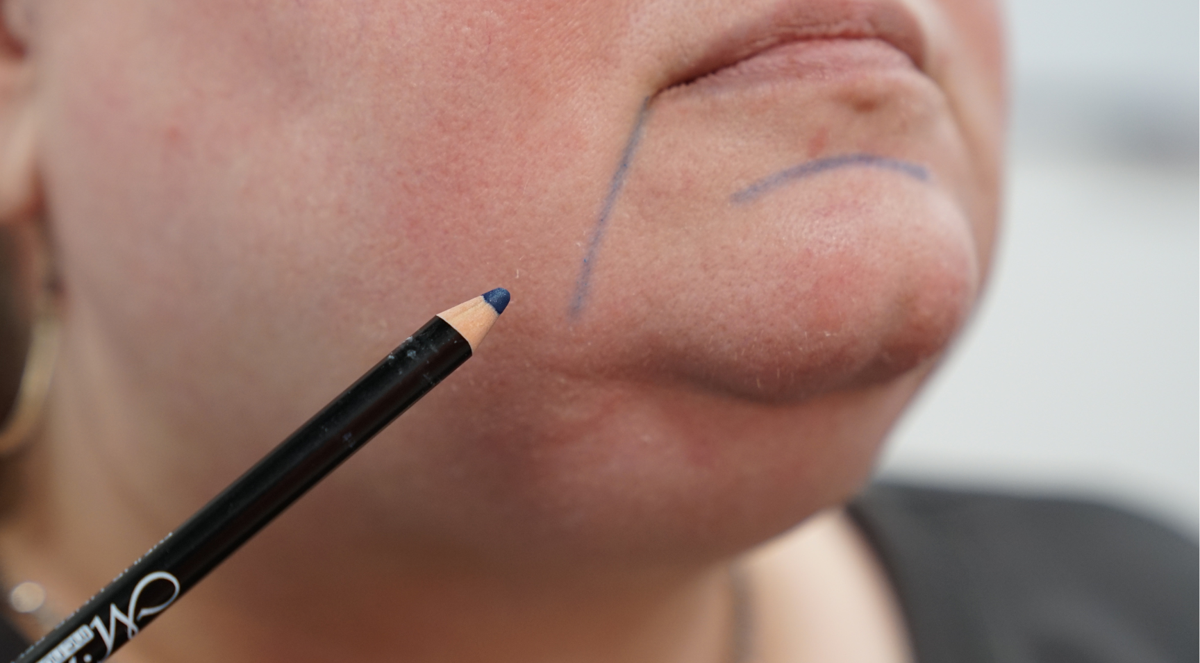 Managing Marionette Lines with Skin Treatments | Harley Academy