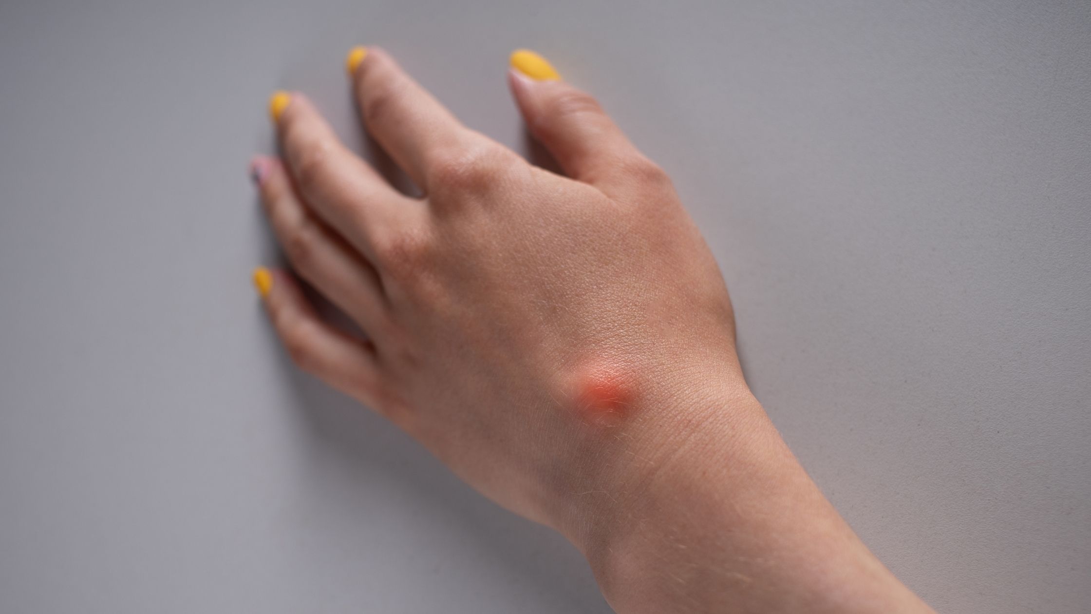 Cyst Removal Recovery: Symptoms, Diagnosis, and Post-Operative Care