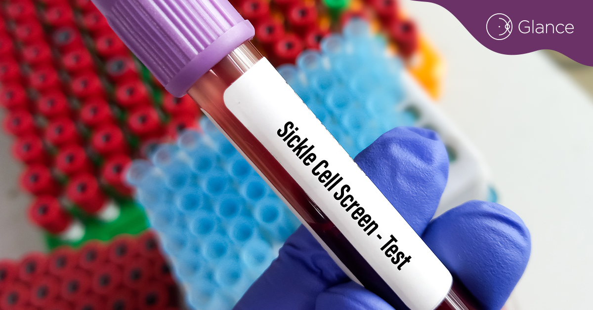 Pediatric sickle cell disease study reports surprising ophthalmic findings