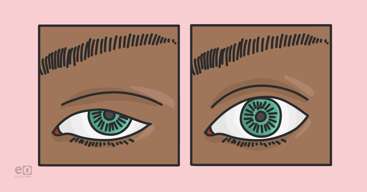 Introduction to Surgical Periocular Rejuvenation