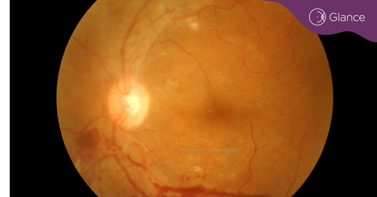 Study suggests retinal age gap can identify high-risk patients for end ...