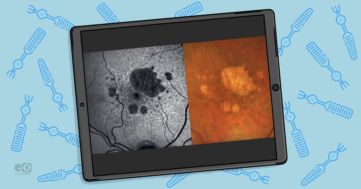 The Pathogenesis of Geographic Atrophy: An Animated Journey