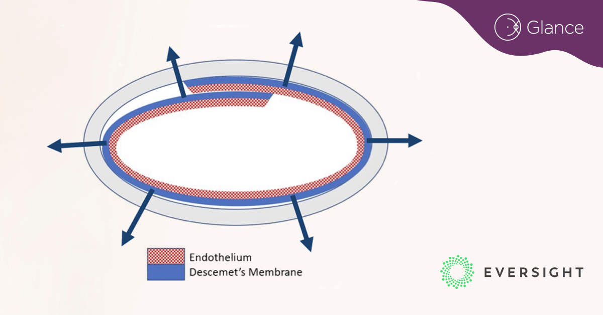 Eversight launches new preloaded DMEK EndoGlide