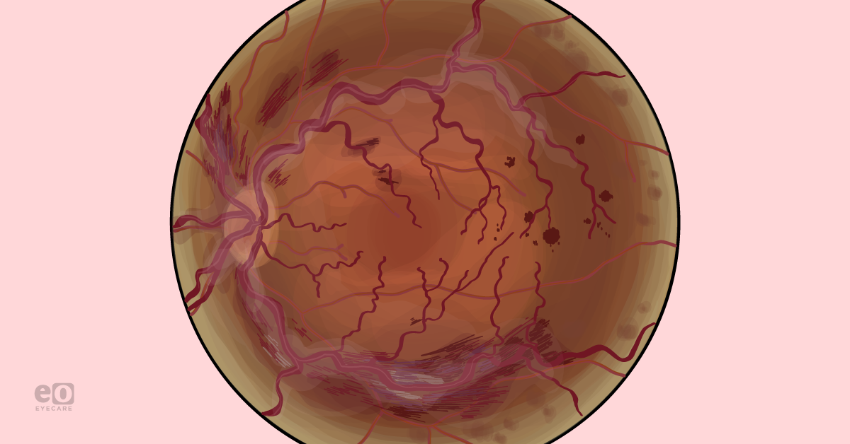 Advances in the Management of Retinal Vein Occlusion