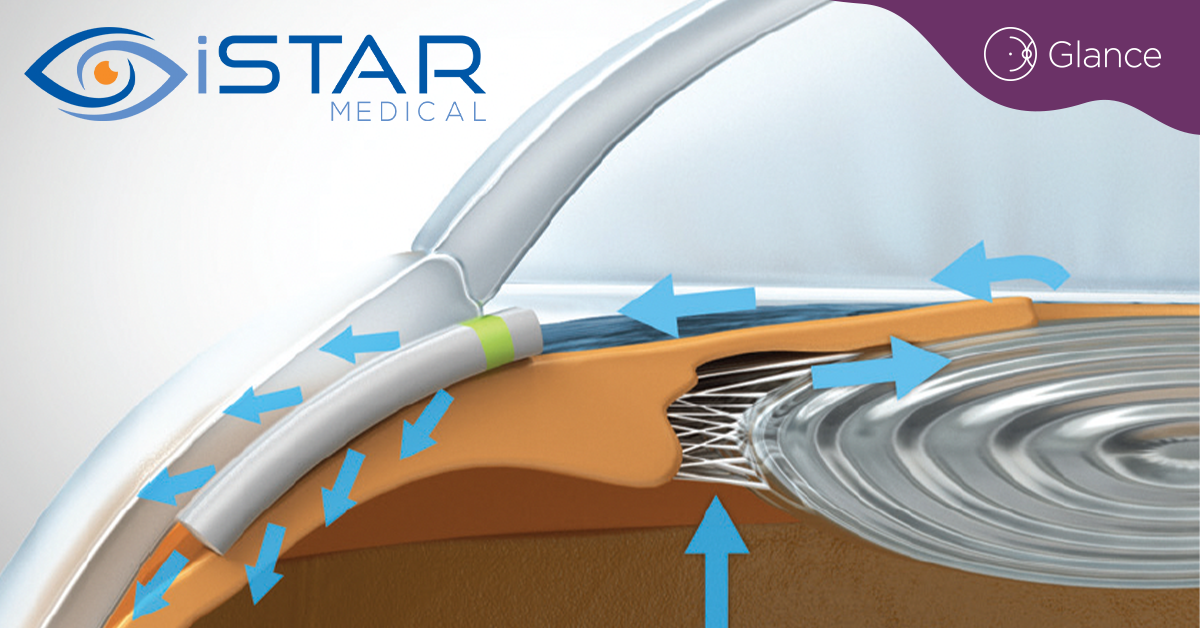 iSTAR Medical launches trial on the use of MIGS device with cataract ...