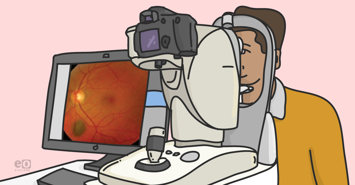 Differential Diagnosis for a Pigmented Fundus Lesion with Downloadable ...