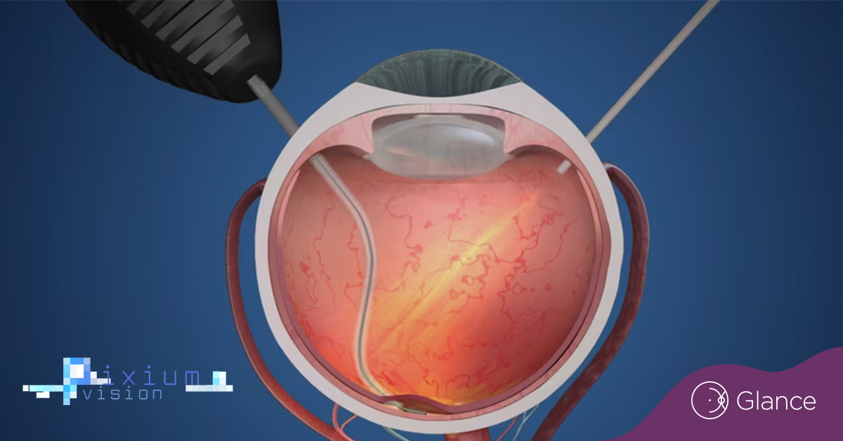 Prima System for dry AMD receives FDA Breakthrough Device Designation