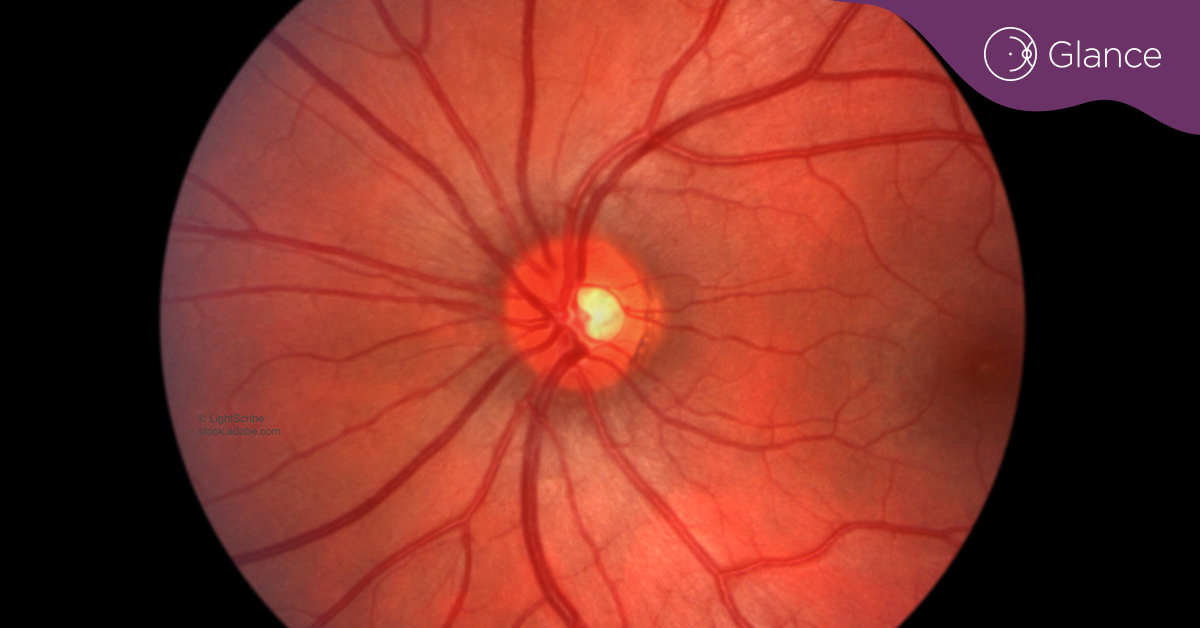 Linking smoking intensity and optic nerve vessel density in glaucoma