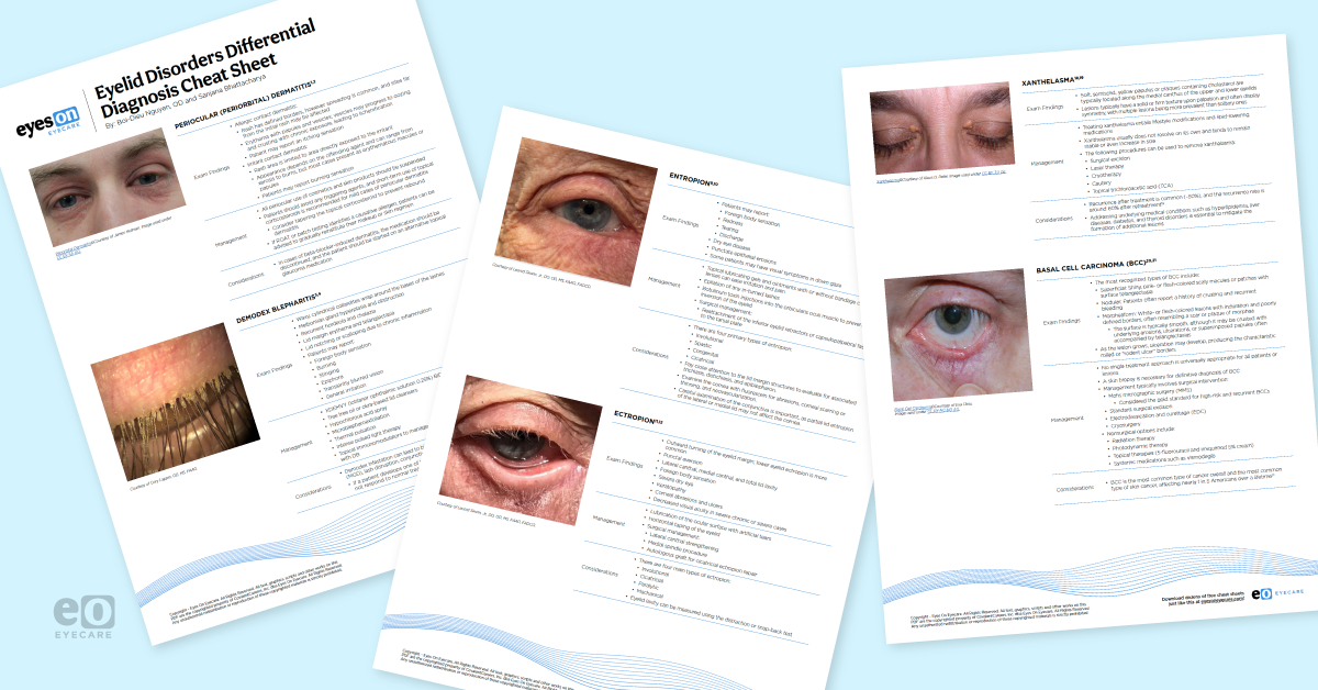 The Optometrist's Guide to Managing Eyelid Disorders with Cheat Sheet