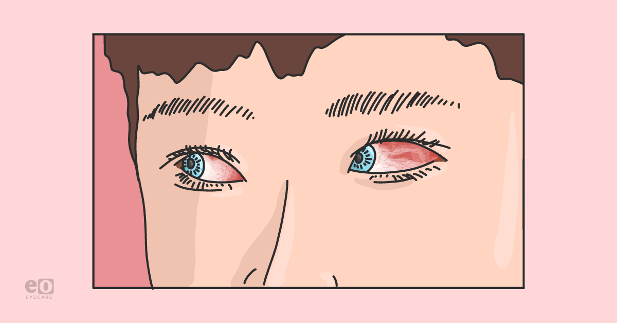 Juvenile Idiopathic Arthritis And Pediatric Uveitis